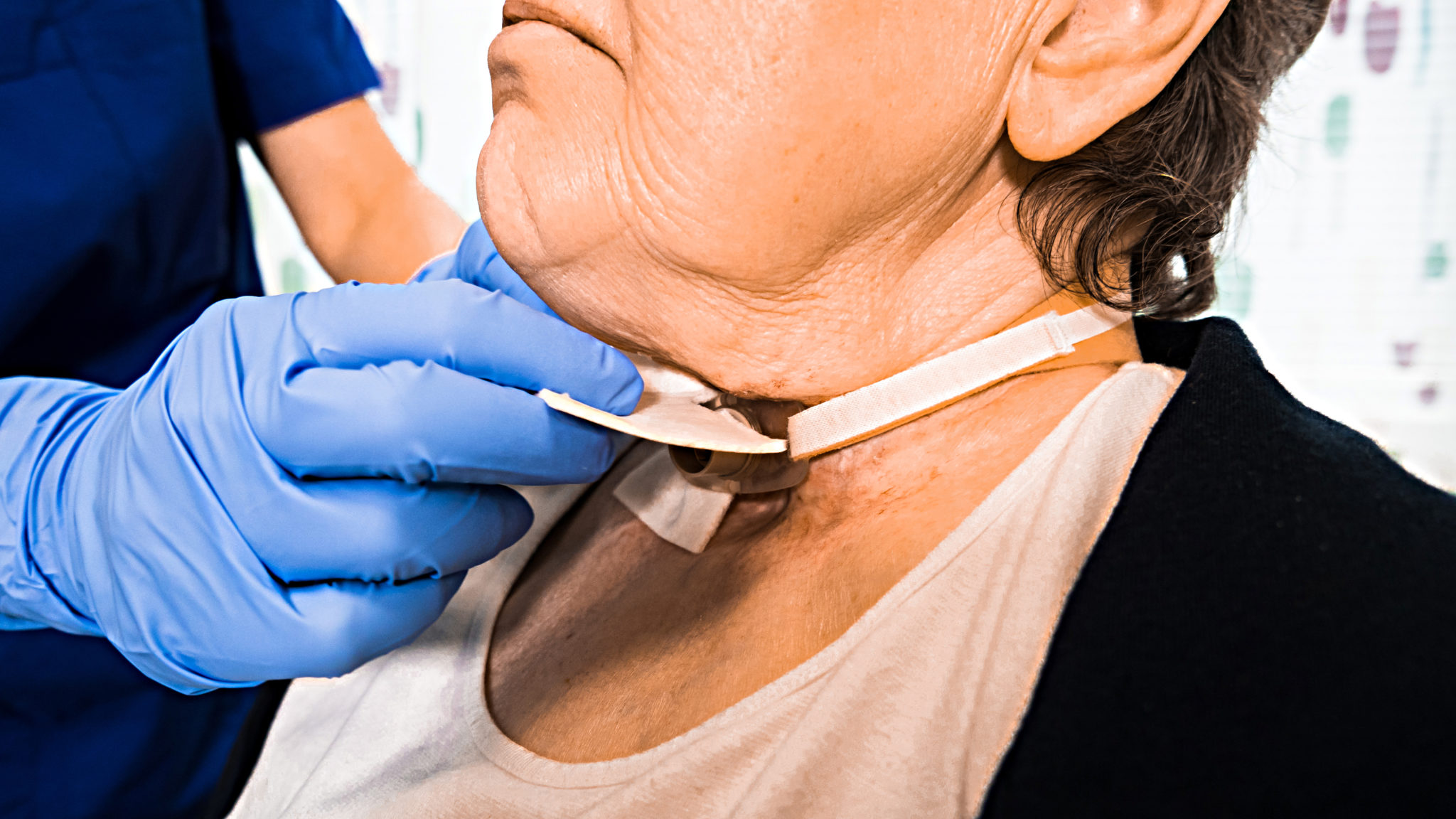 Omläggning/kanylbandsbyte – Trakeostomihandboken